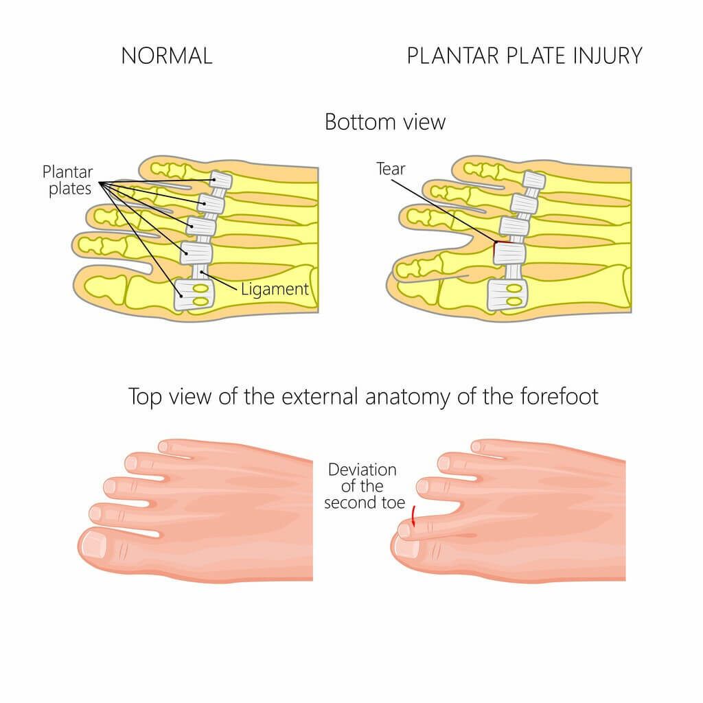 Plantar Plate Tears - Bradley Physio