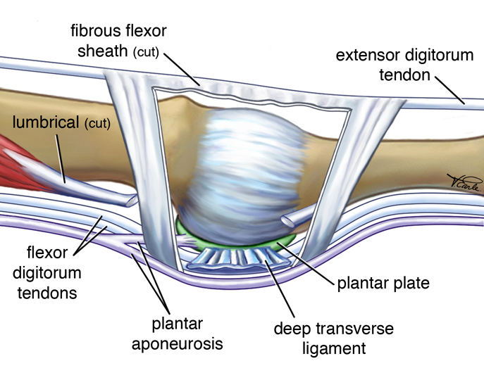 Plantar Plate Tears - Bradley Physio